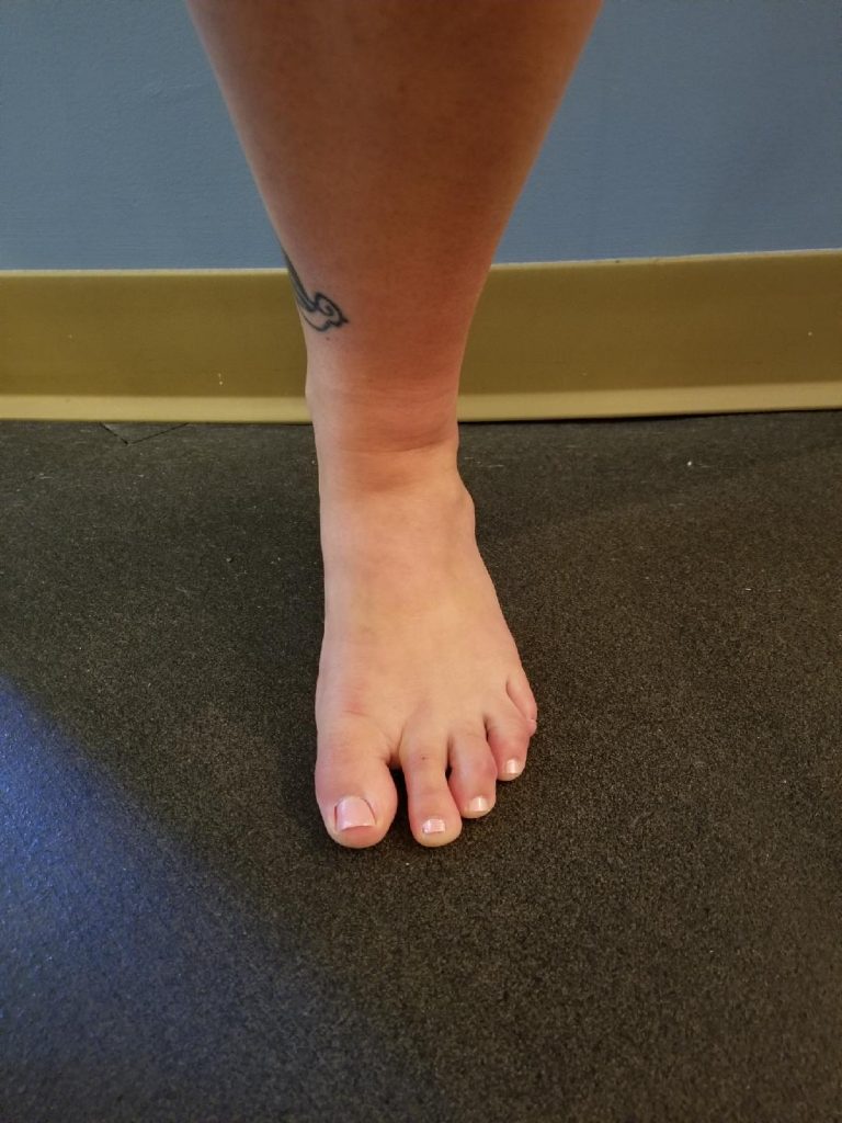 Foot Structure and Function - Pronation - IPA Physio