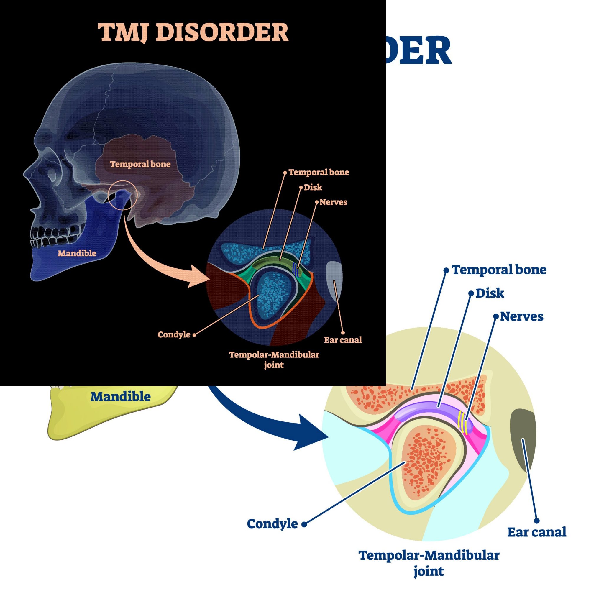TMJ disorder vector illustration. Labeled jaw condition educational ...