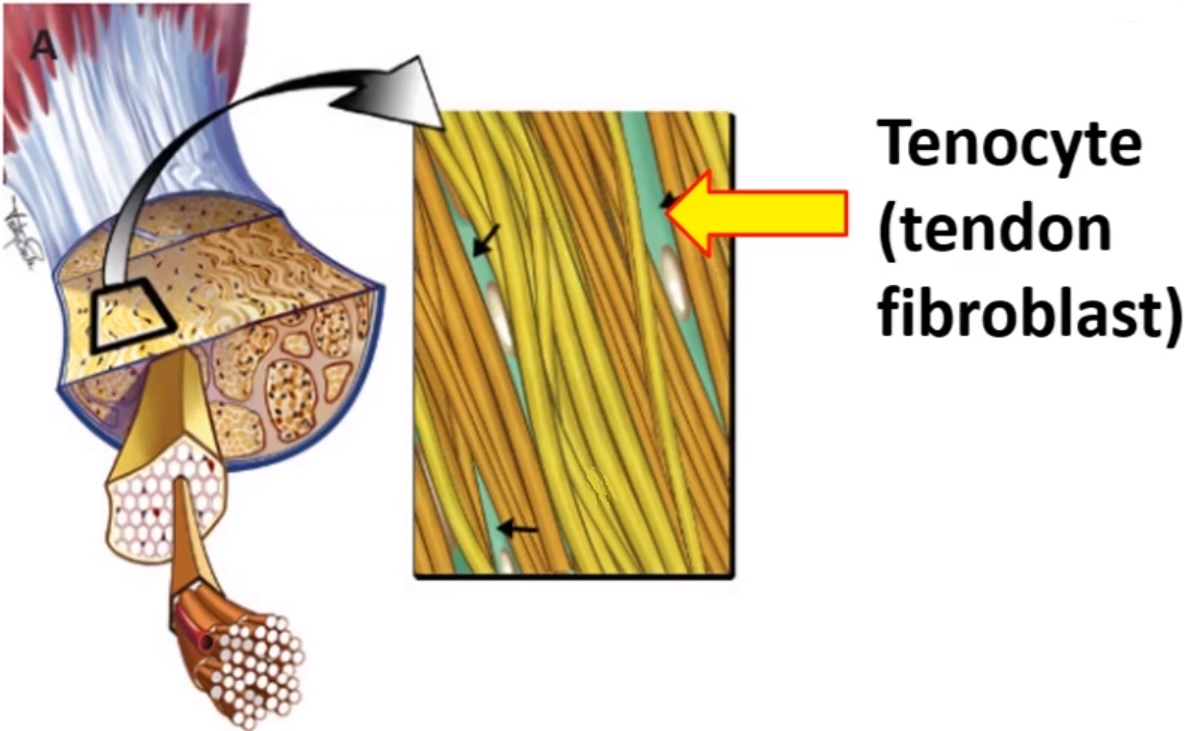 IPA Physio Photobiomodulation: Tendinitis or Tendinosis?