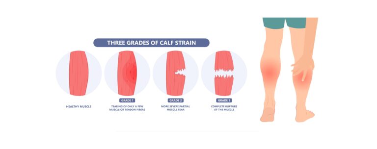 Return to Play Guidelines - Muscle Strains - IPA Physio